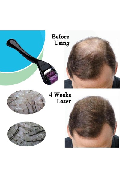 Qniay 540 İğneli 0.5 - 1 mm Derma Roller Saç Cilt Yüz Tarak Qniay 540 İğneli 0.5 - 1 mm Derma Roller Saç Cilt Yüz Tarak