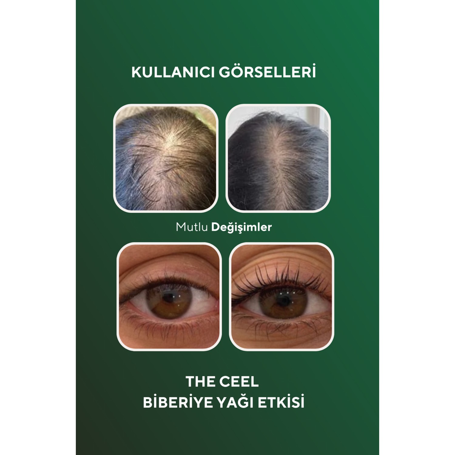 The Ceel Biberiye Yağı Complexi Sac Dokulmesi ve Asiri Yipranmis Saclar ...